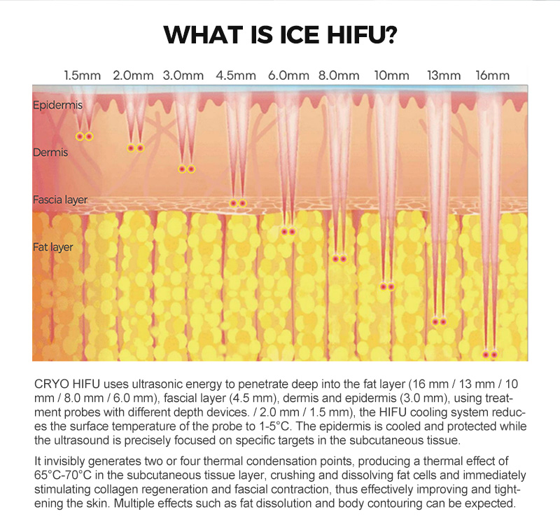 Smas Lifting Cooling Hifu Cool Hifu Ice Machine from China Manufacturer ...